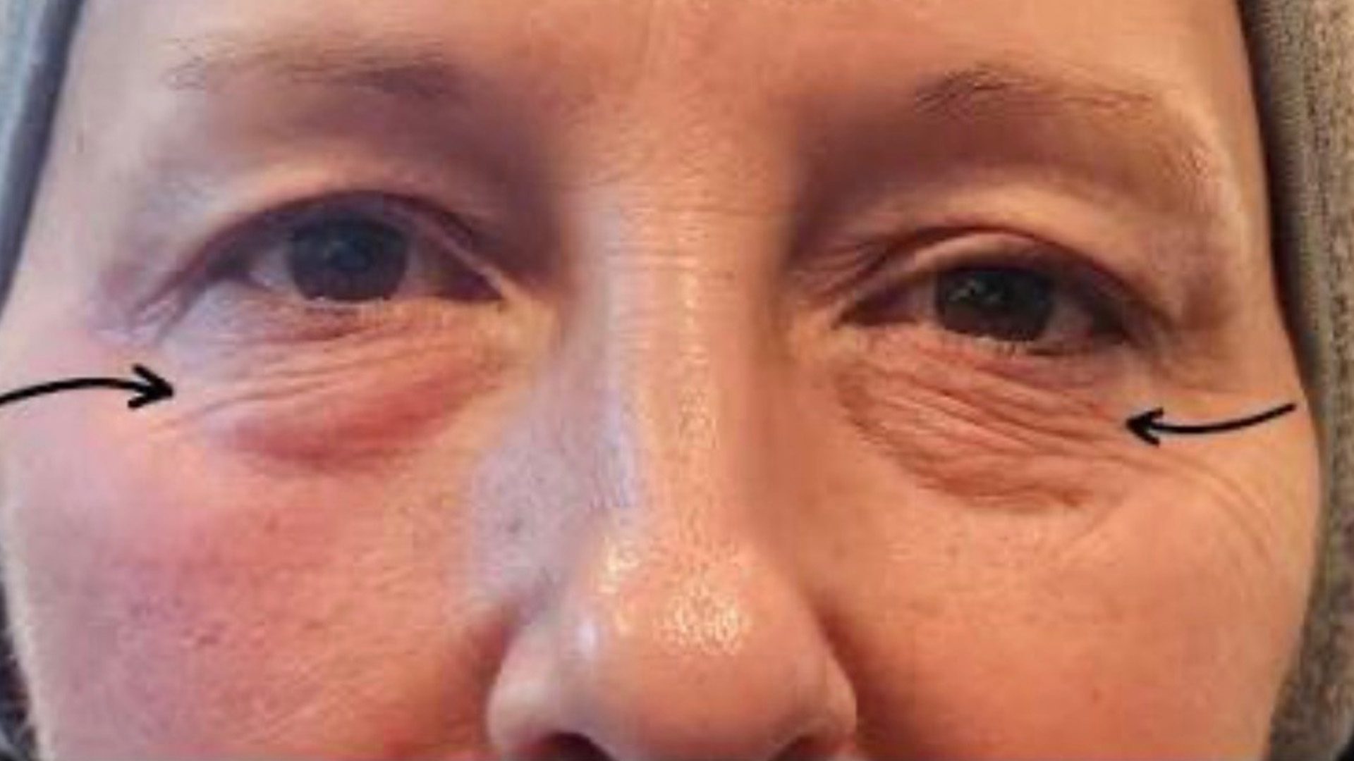 Lumenis OptiLIFT: New Technology for a Gentle Eyelid and Facelift ...